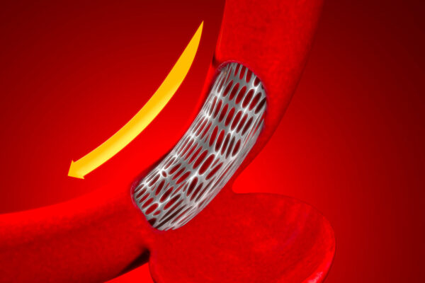 Endovascular Aneurysm Repair (EVAR) Your Complete Guide