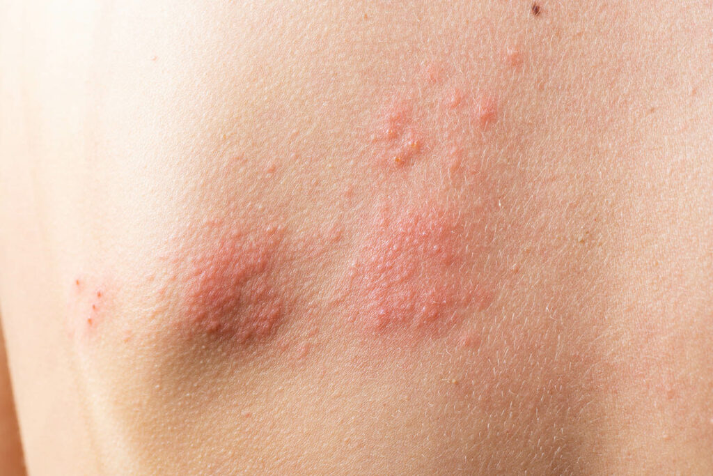 Identifying Hives: Common Symptoms and Visual Guide