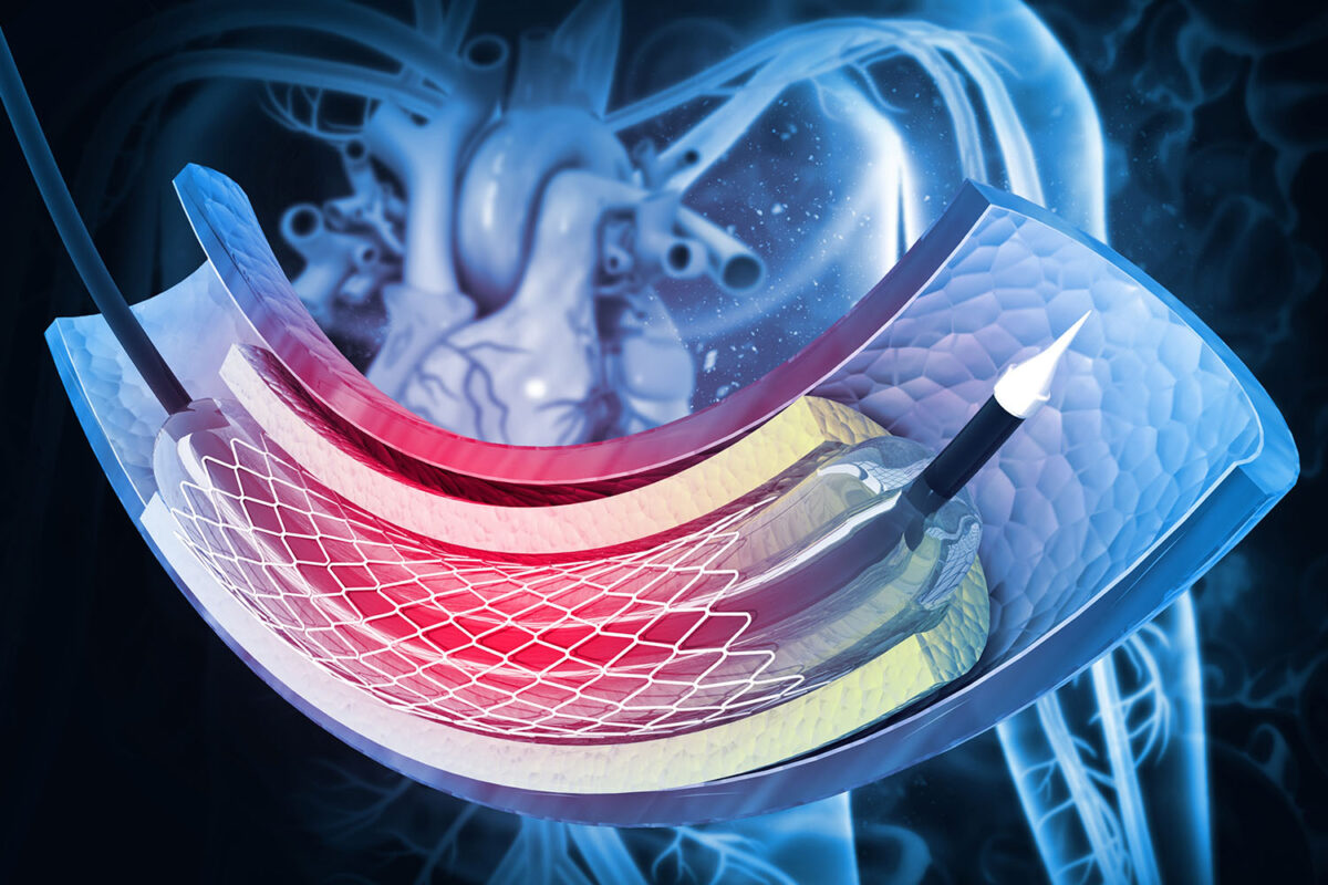 Angiogram - Eremedium