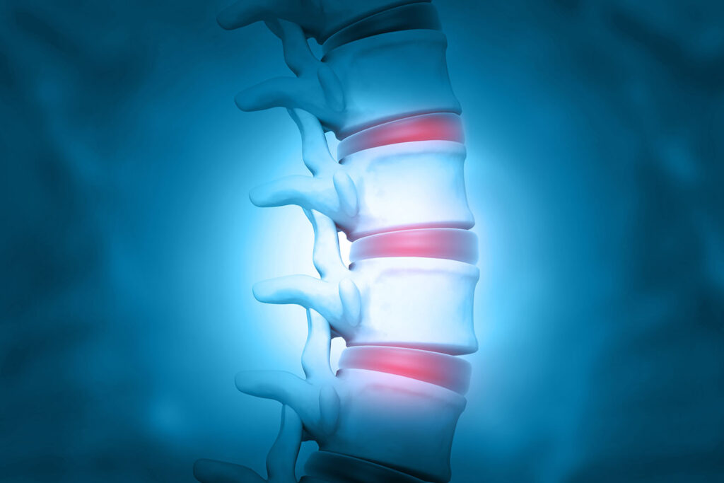 Discectomy - Eremedium
