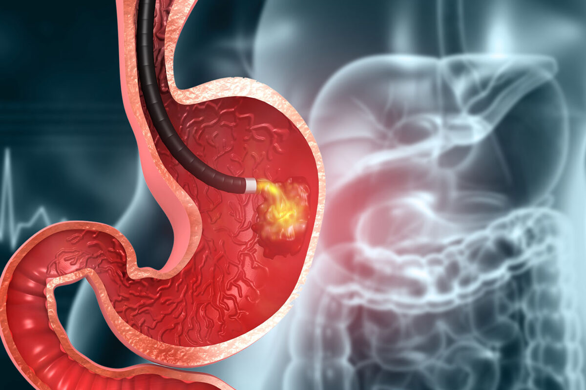 Gastritis Treatment - Eremedium