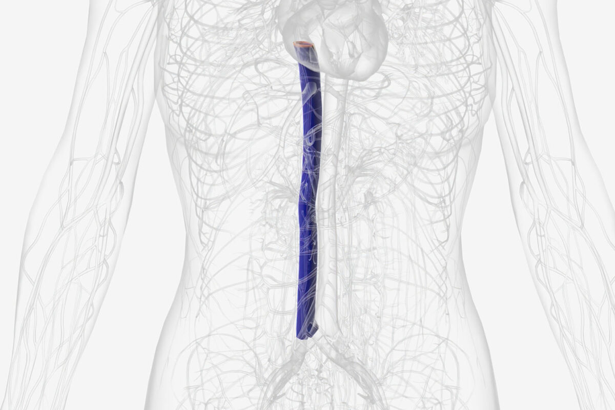 IVC filter - Eremedium