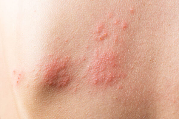 Skin Hives: Causes, Symptoms, and Treatments | ERemedium