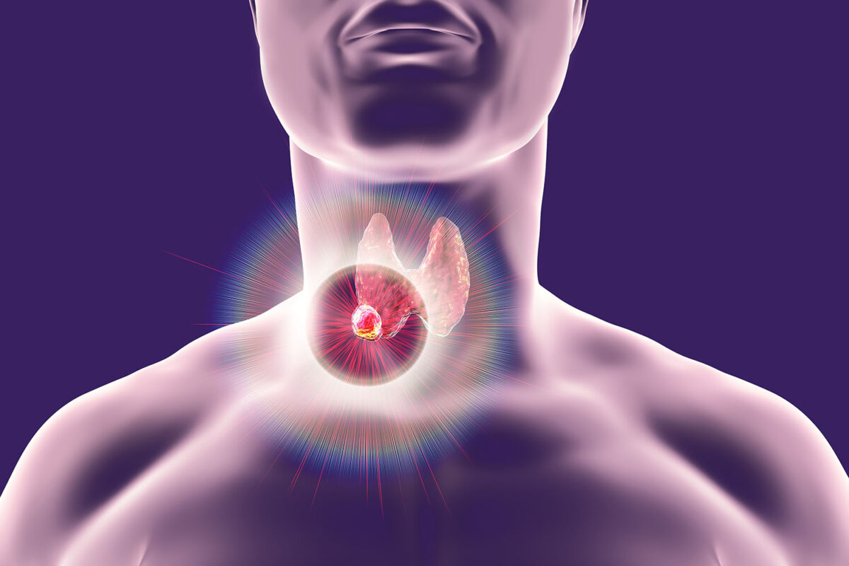 The Complete Guide to Thyroid Surgery | ERemedium