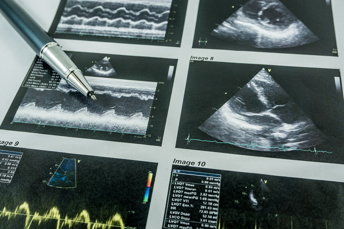 What does an Echocardiogram show - Eremedium