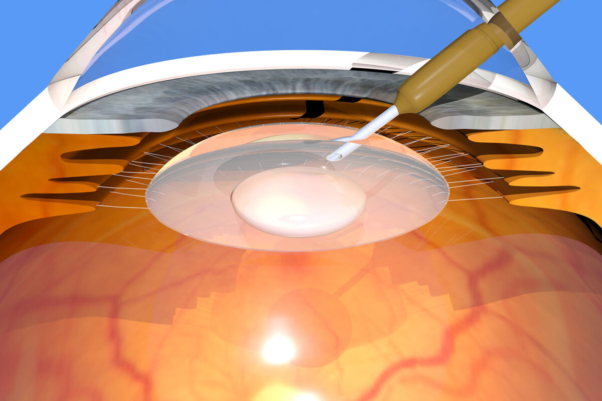 Phacoemulsification - Eremedium