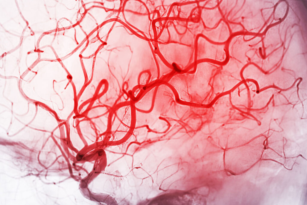 Angiogram risk of Death - Eremedium