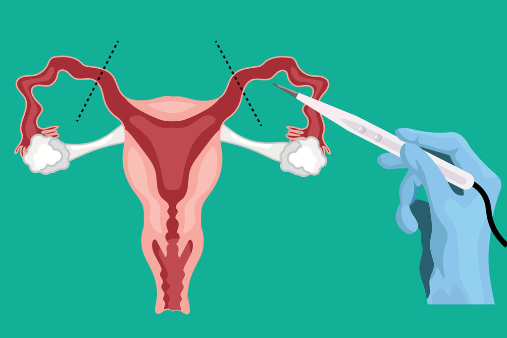 Vasectomy and Tubectomy - Eremedium