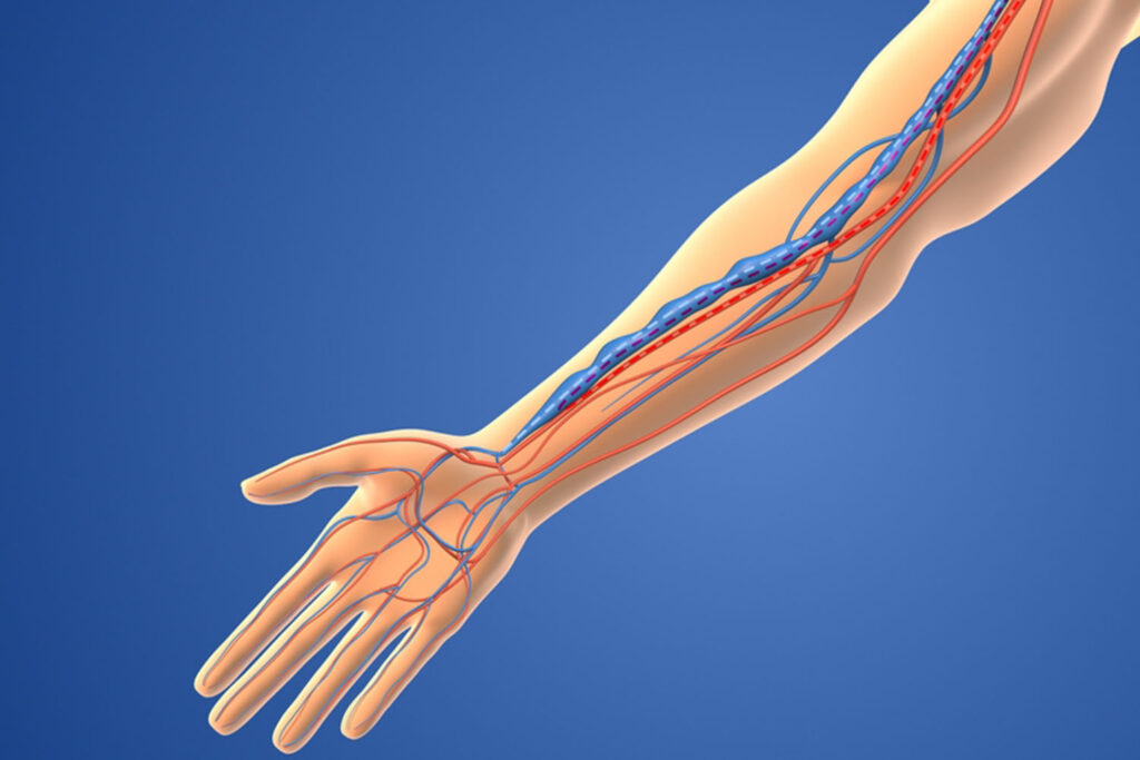 AV Fistula for Dialysis - Eremedium