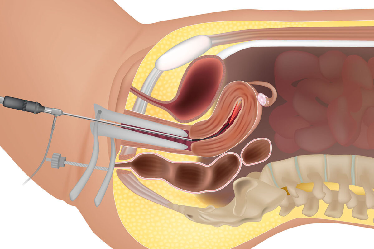 Hysteroscopic Polypectomy - Eremedium