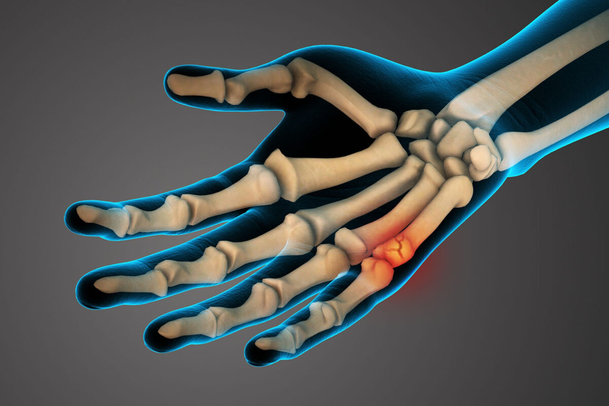 Metacarpal Fracture - Eremedium