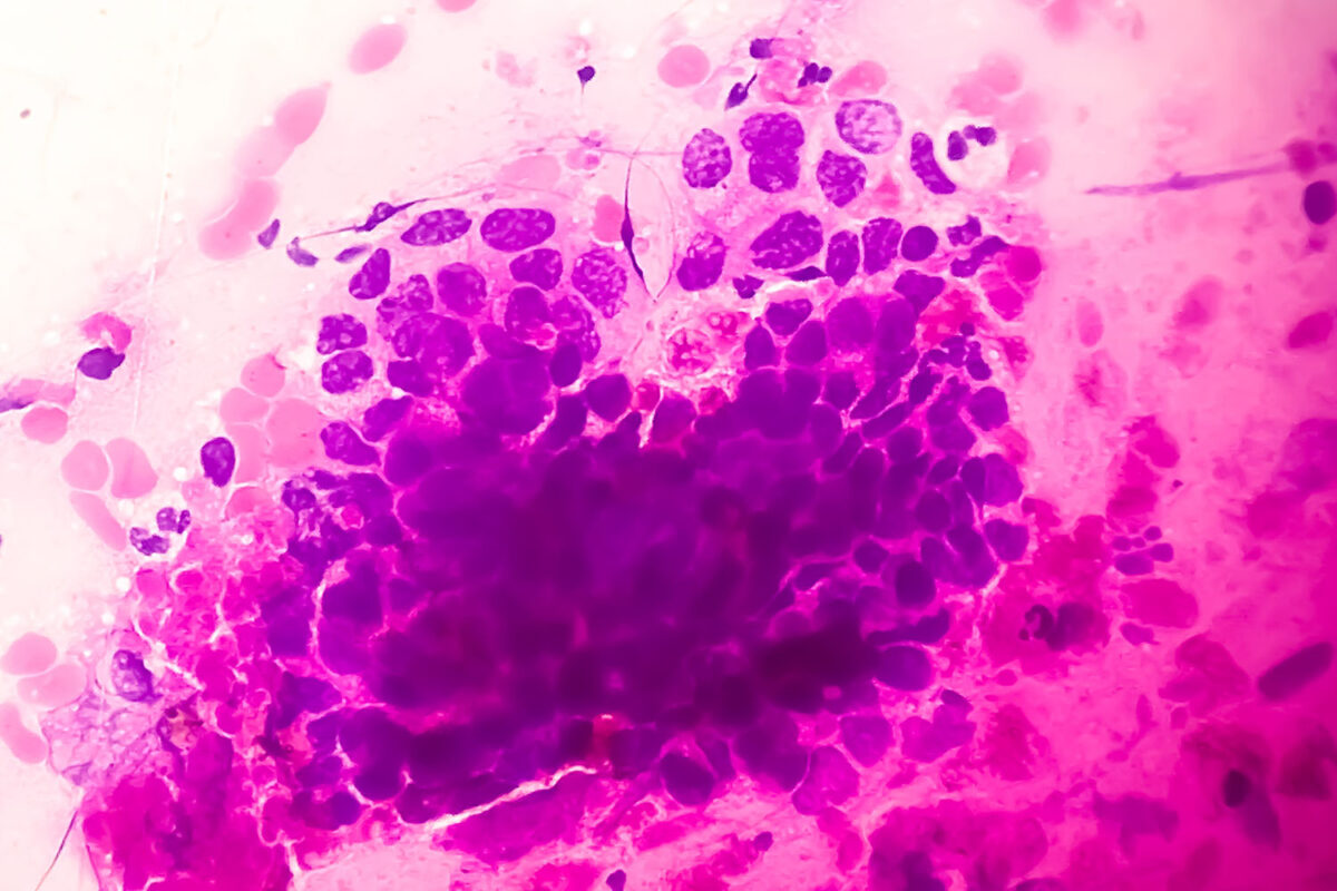 Pap Stain Procedure - Eremedium