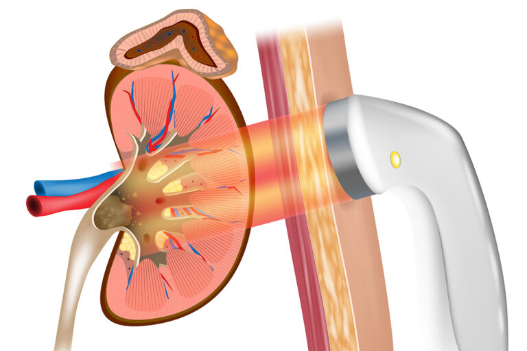 ESWL Procedure - Eremedium